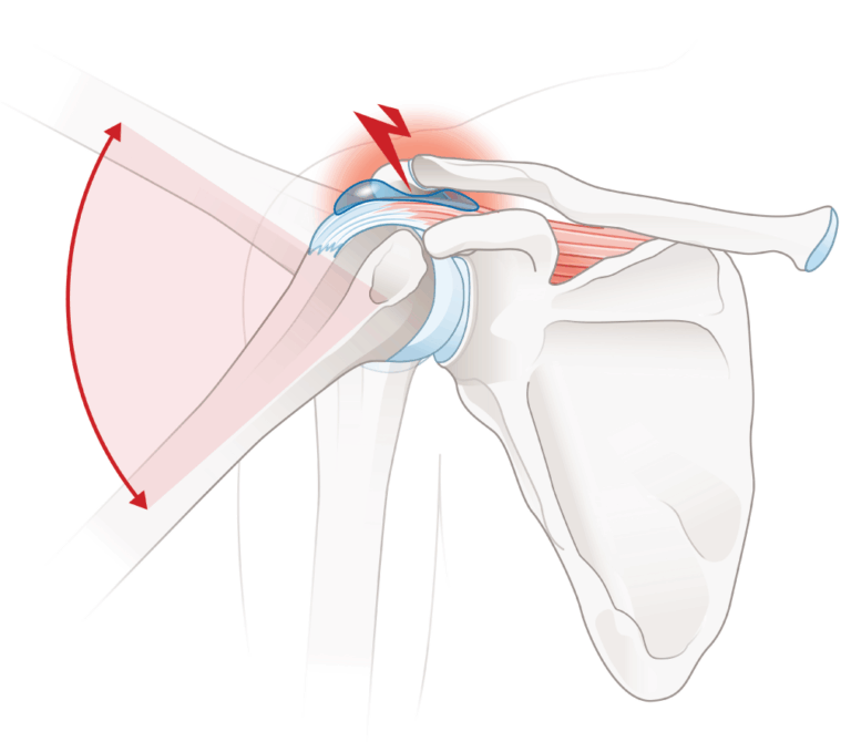 Treat SHOULDER IMPINGEMENT SYNDROME in Lansing, MI | Michigan ...